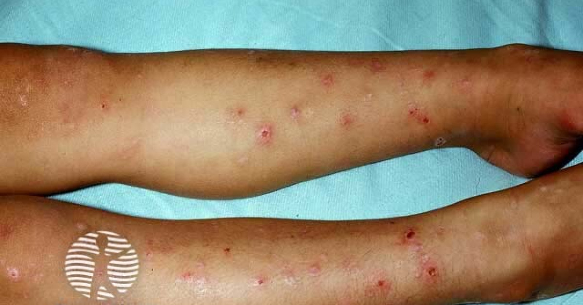 Papular urticaria image