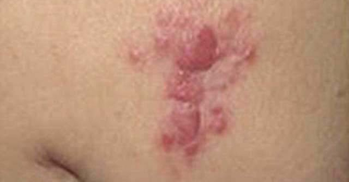 Primary cutaneous follicle centre lymphoma, B-cell lymphoma image