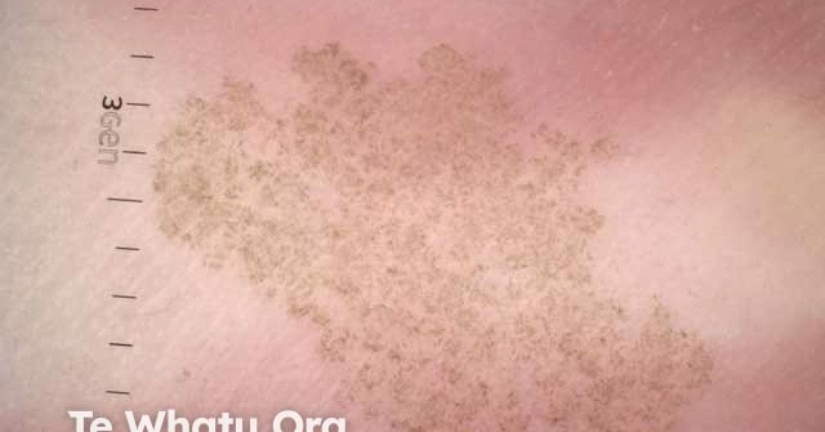 Tinea nigra image