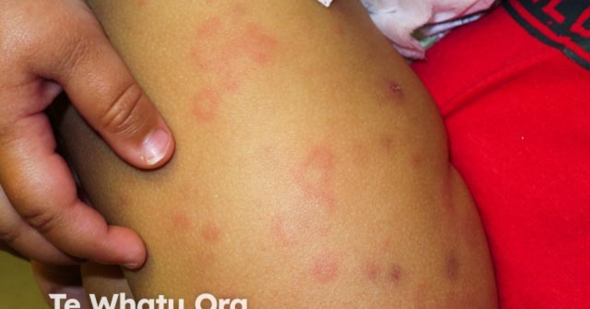 urticarial vasculitis 00004 image