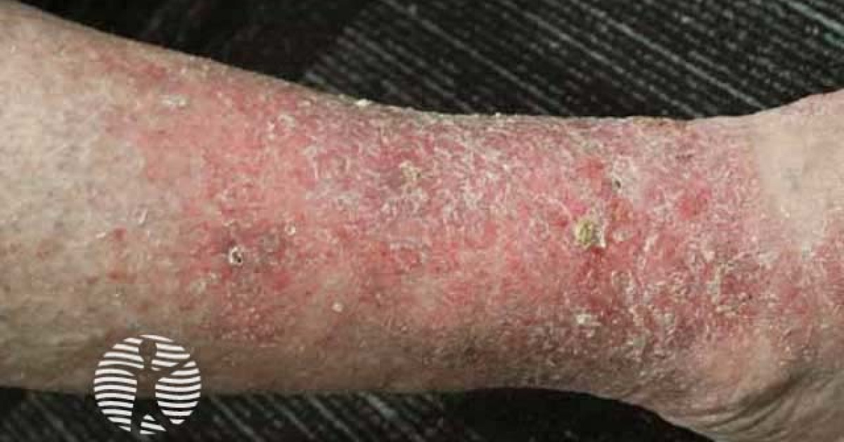venous eczema 001 image