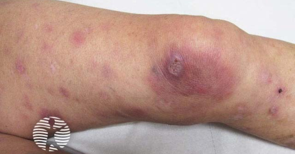 primary cutaneous anaplastic large cell lymphoma 00008 image