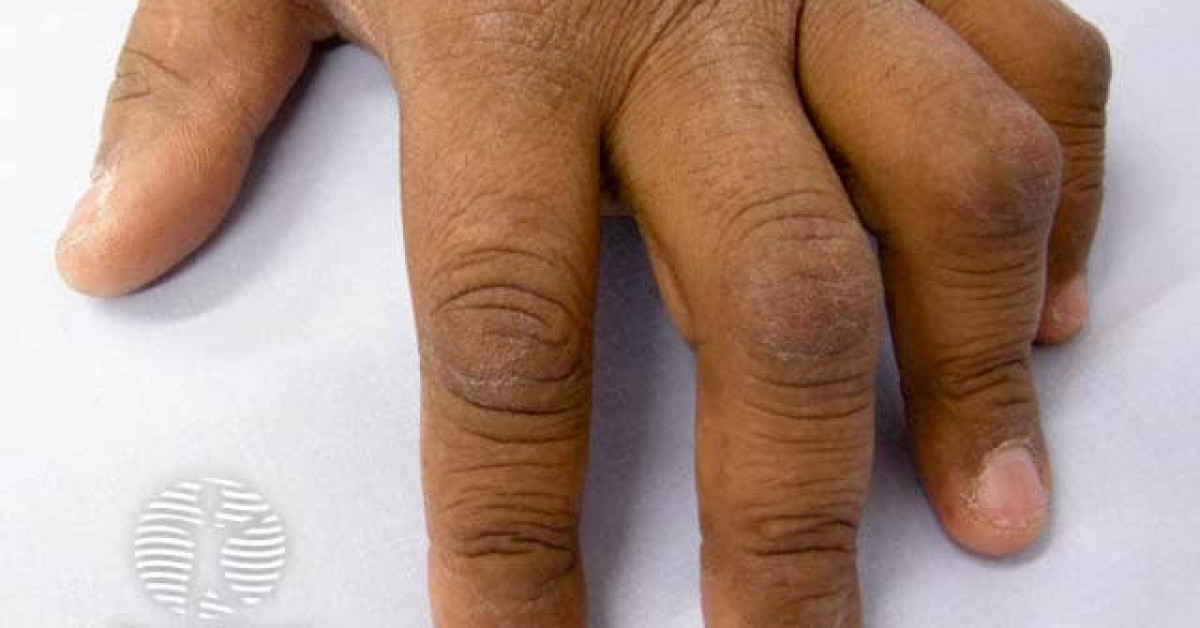 Acanthosis nigricans image