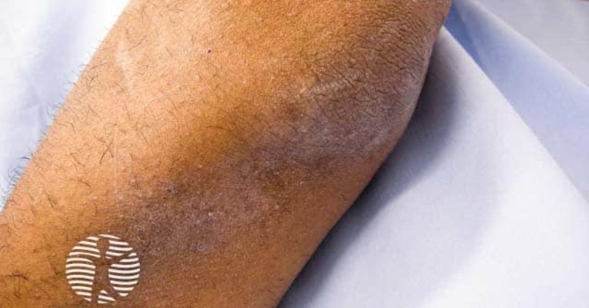 Acanthosis nigricans image