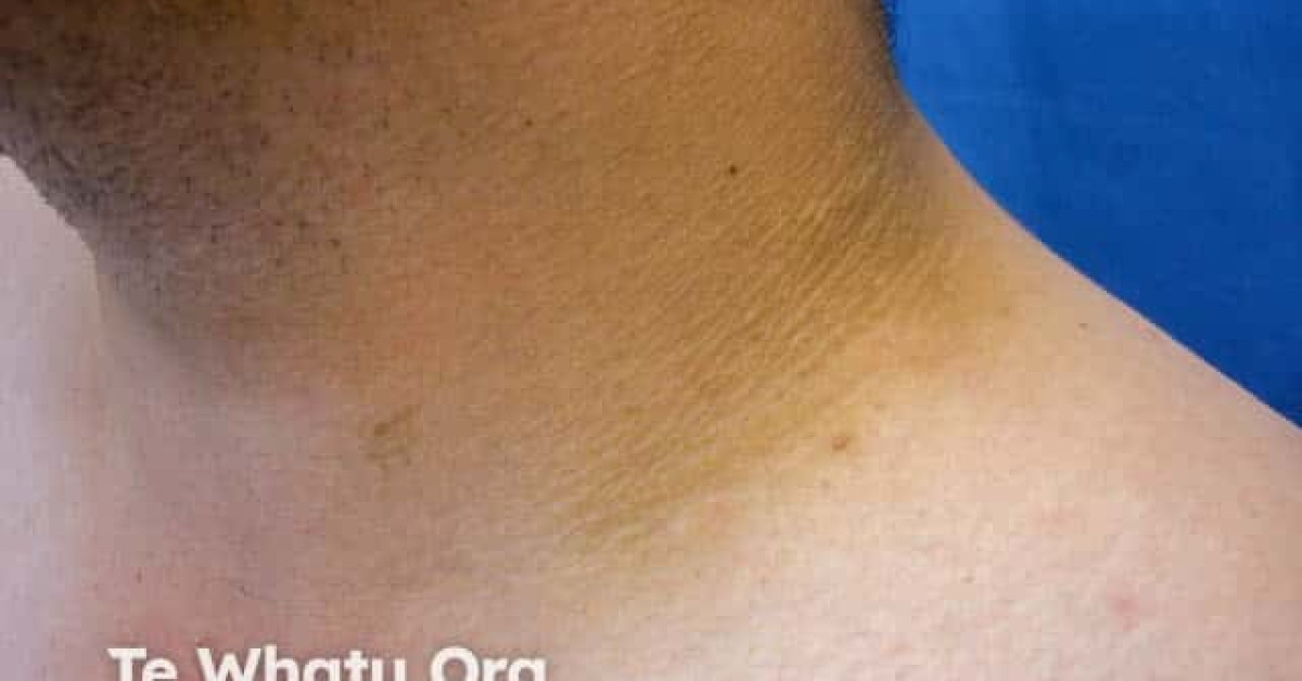 Acanthosis nigricans image