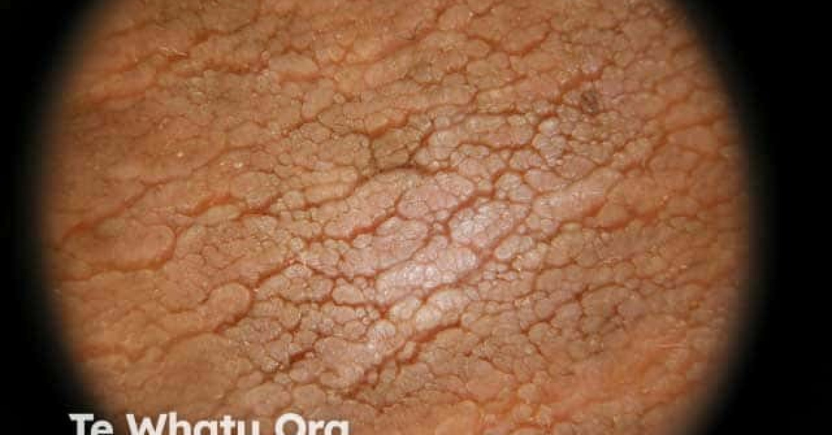 Acanthosis nigricans image