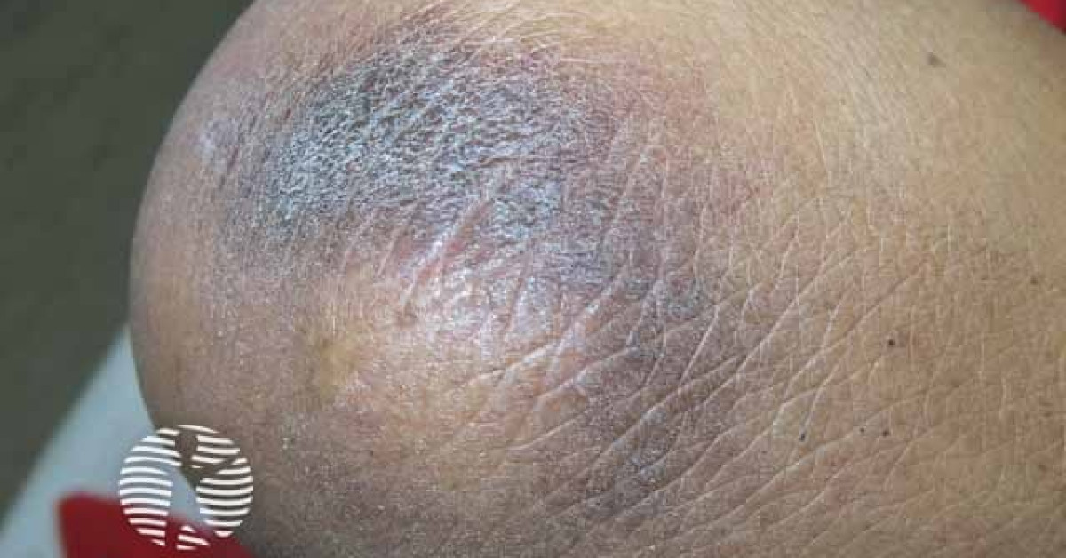Acanthosis nigricans image