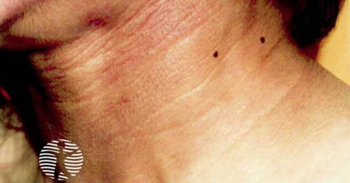 Acanthosis nigricans image