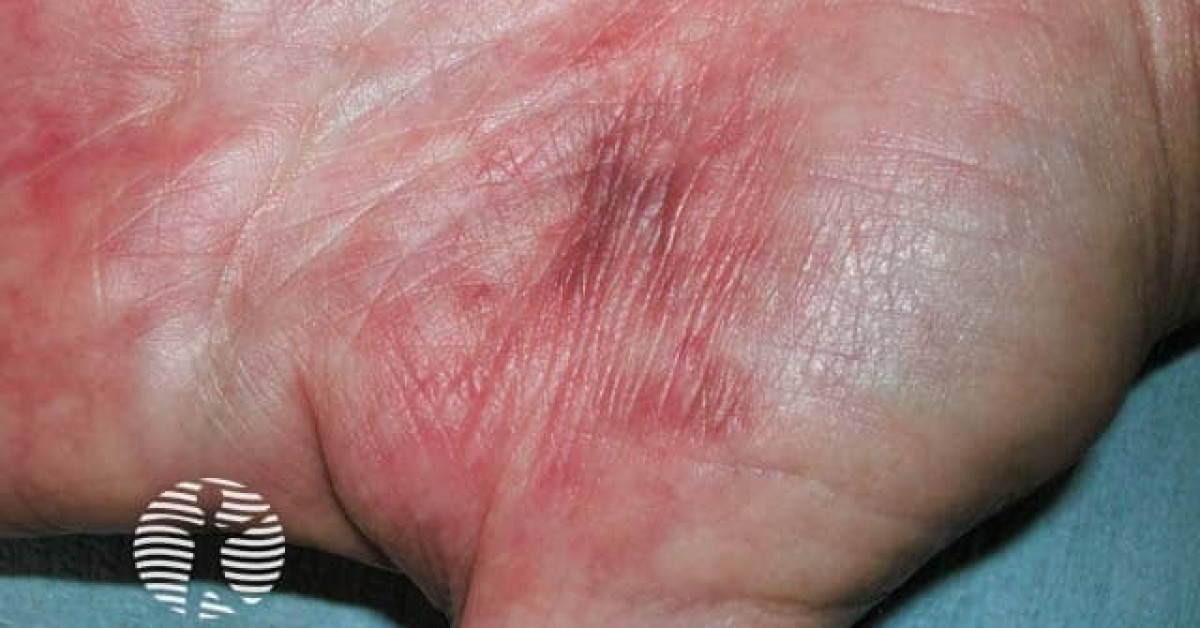 achenbach syndrome 00001 image