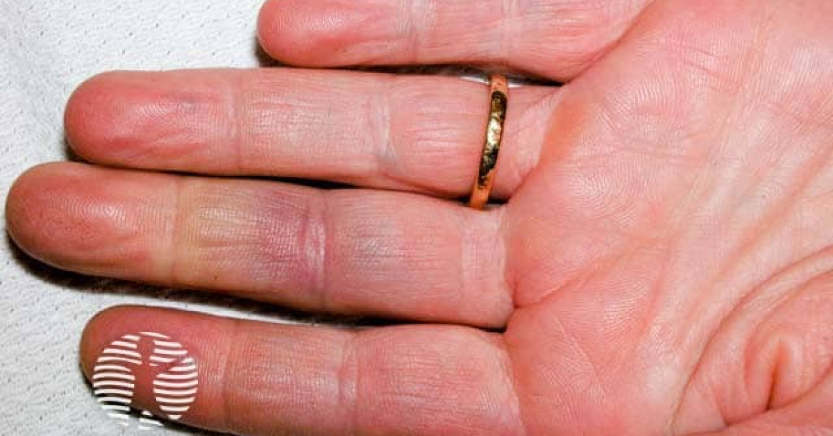 achenbach syndrome 00002 image