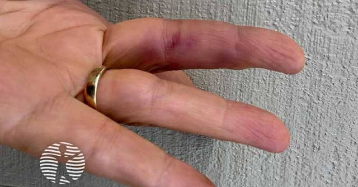 DermNet® - Achenbach syndrome image