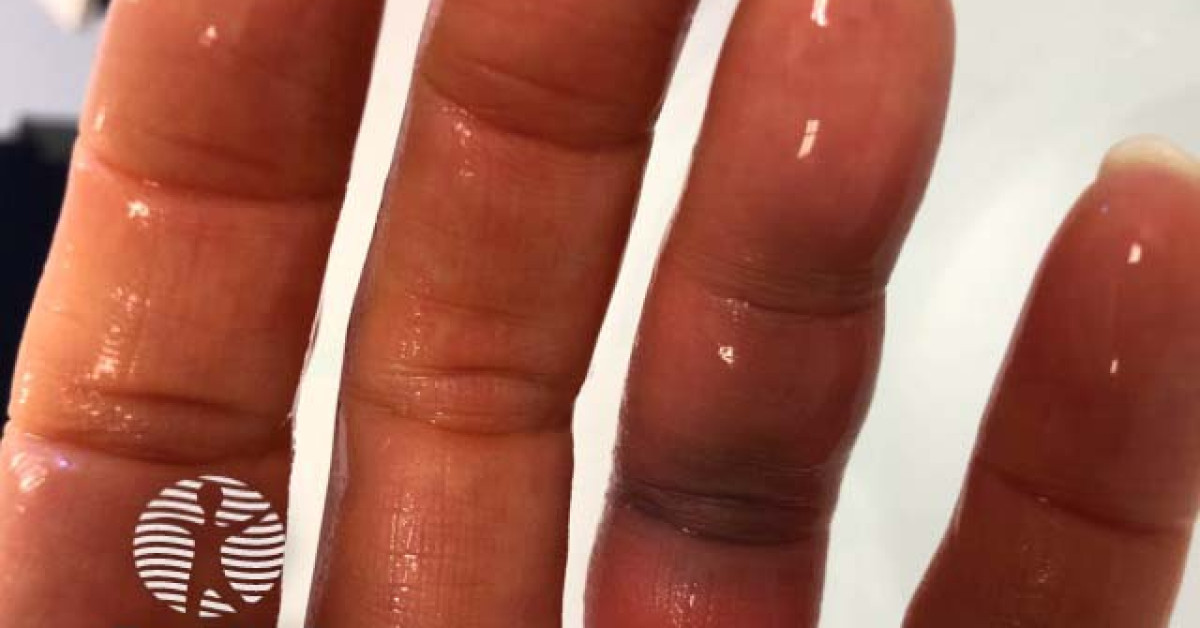 Achenbach syndrome image