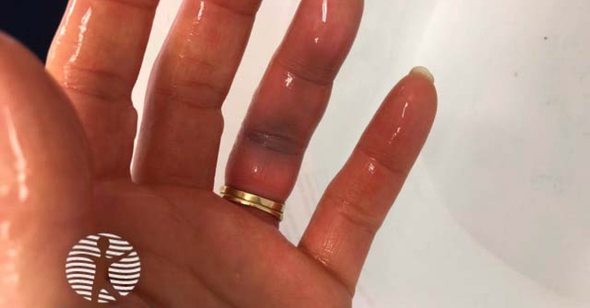 Achenbach syndrome image