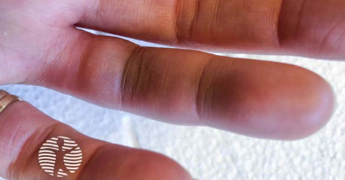 Achenbach syndrome image