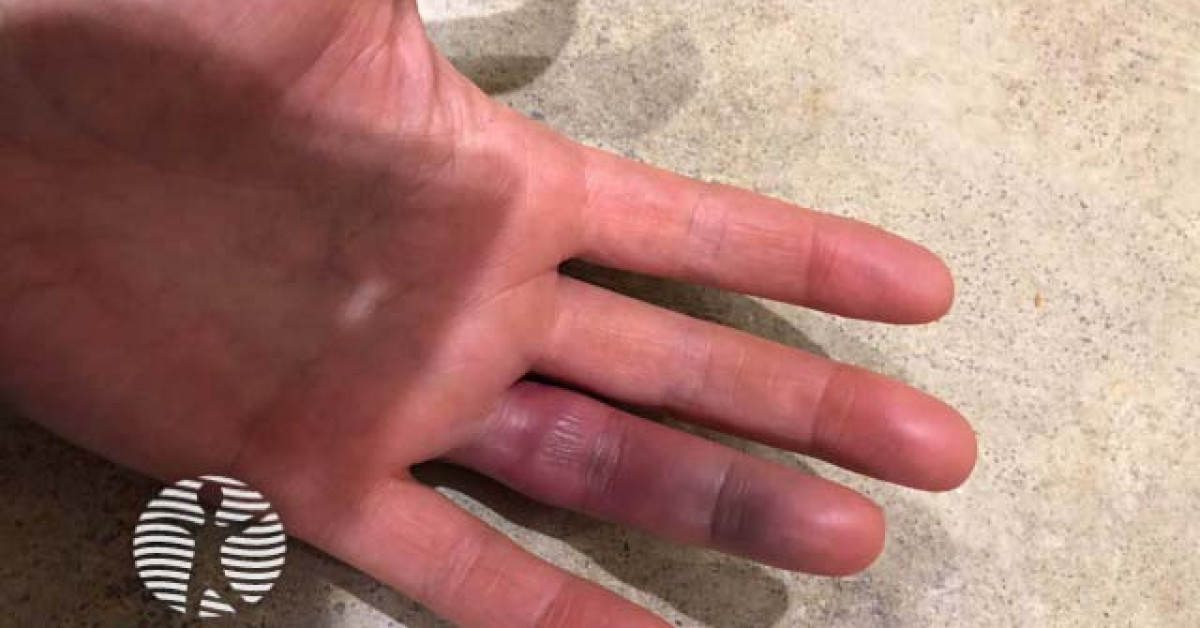 Achenbach syndrome image