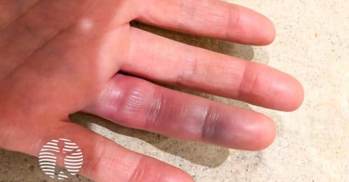 achenbach syndrome 00009 image