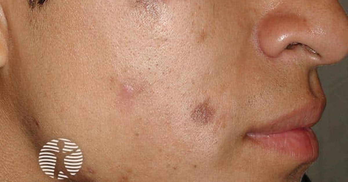 Acne scarring image