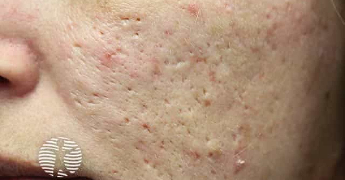 Acne scarring image