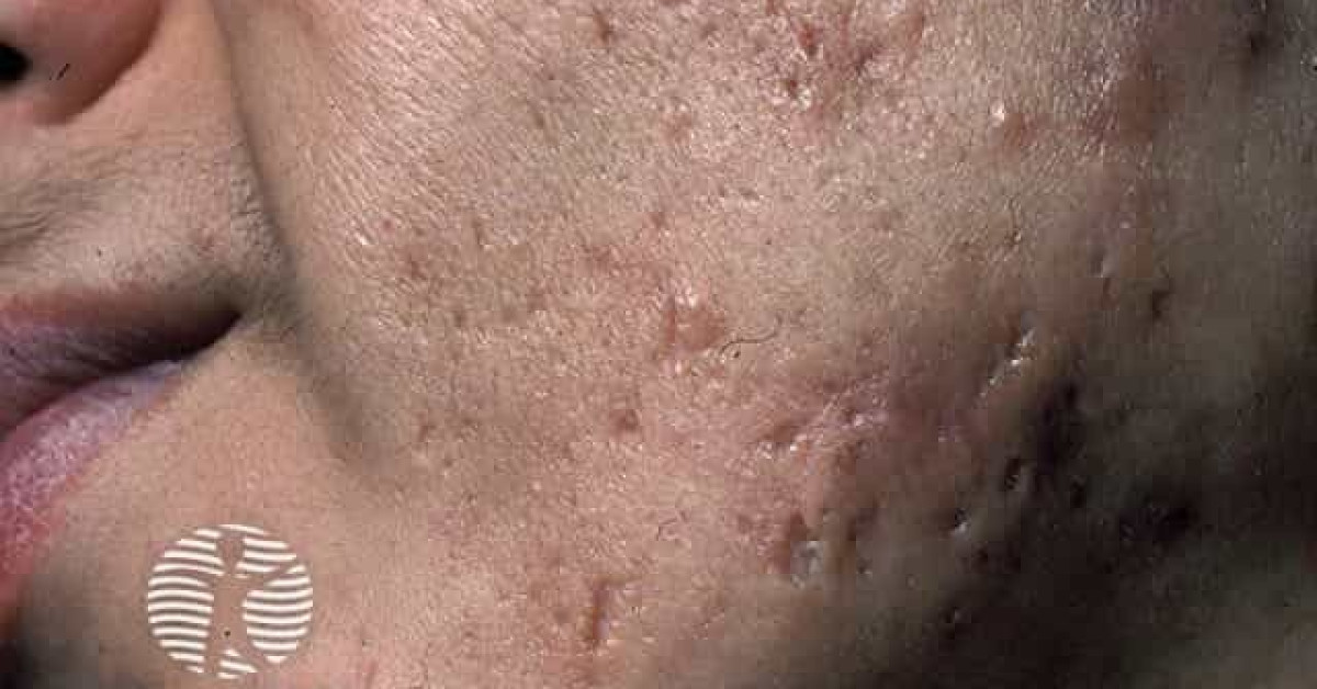 Acne scarring image