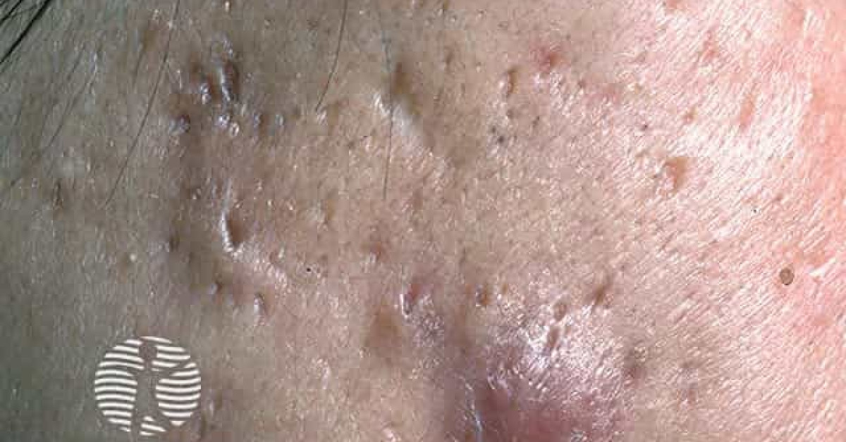 Acne scarring image