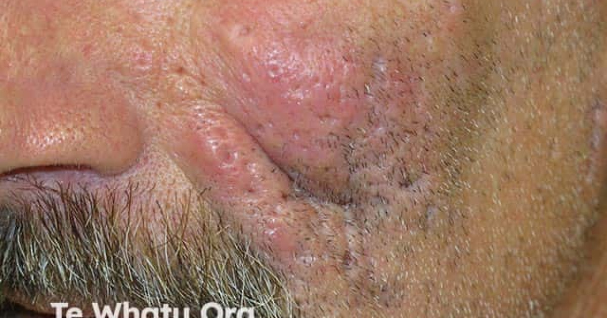 Acne scarring image