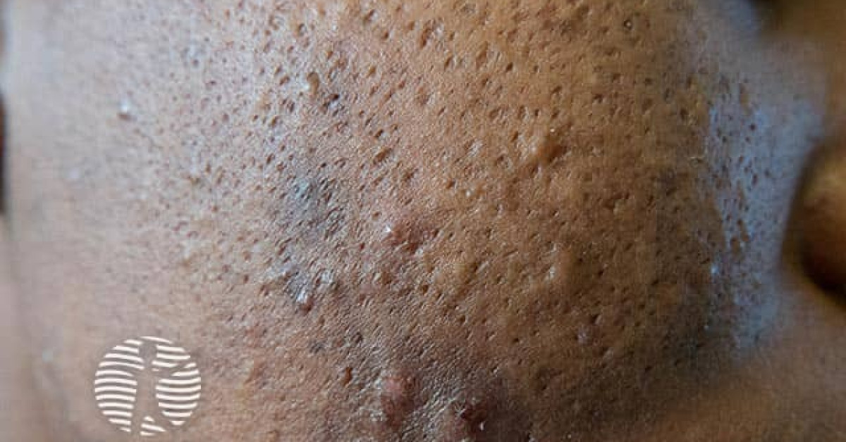 Acne scarring image