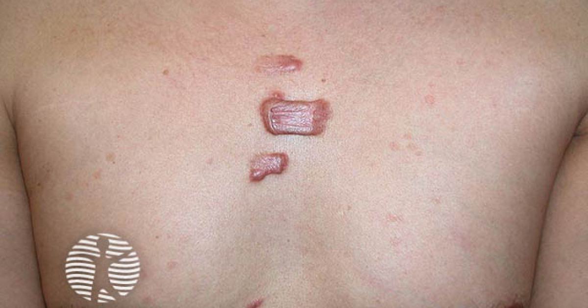 Acne scarring image