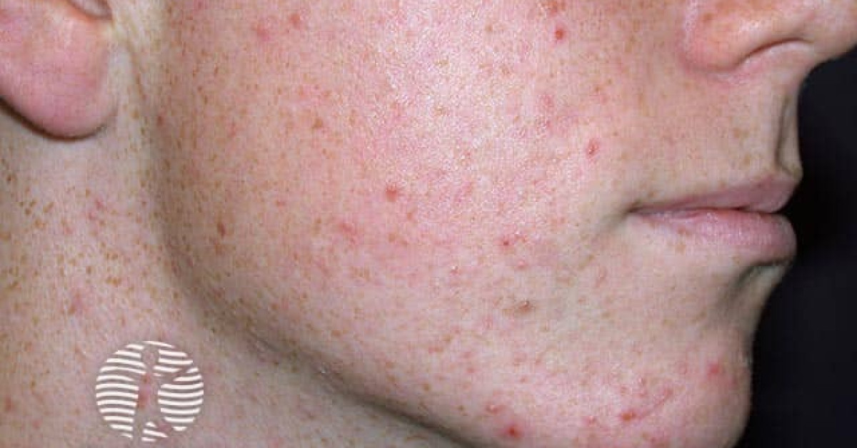 Acne vulgaris image