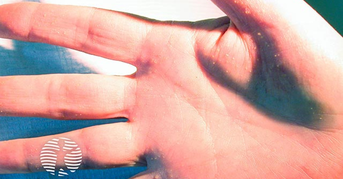 Acquired palmoplantar keratoderma image
