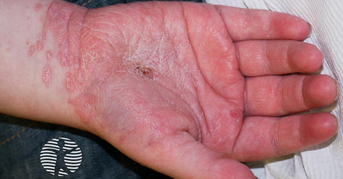 Acquired palmoplantar keratoderma image