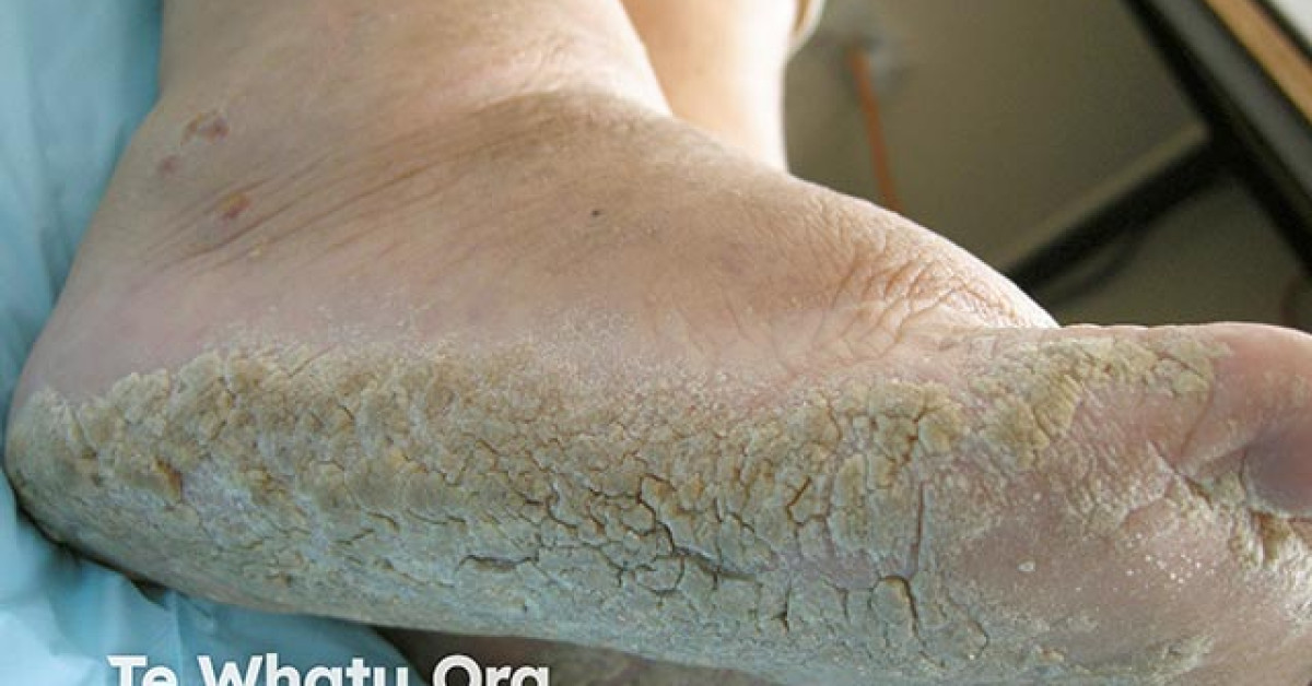 Acquired palmoplantar keratoderma image