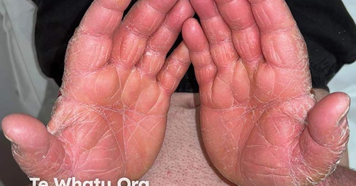 Acquired palmoplantar keratoderma image