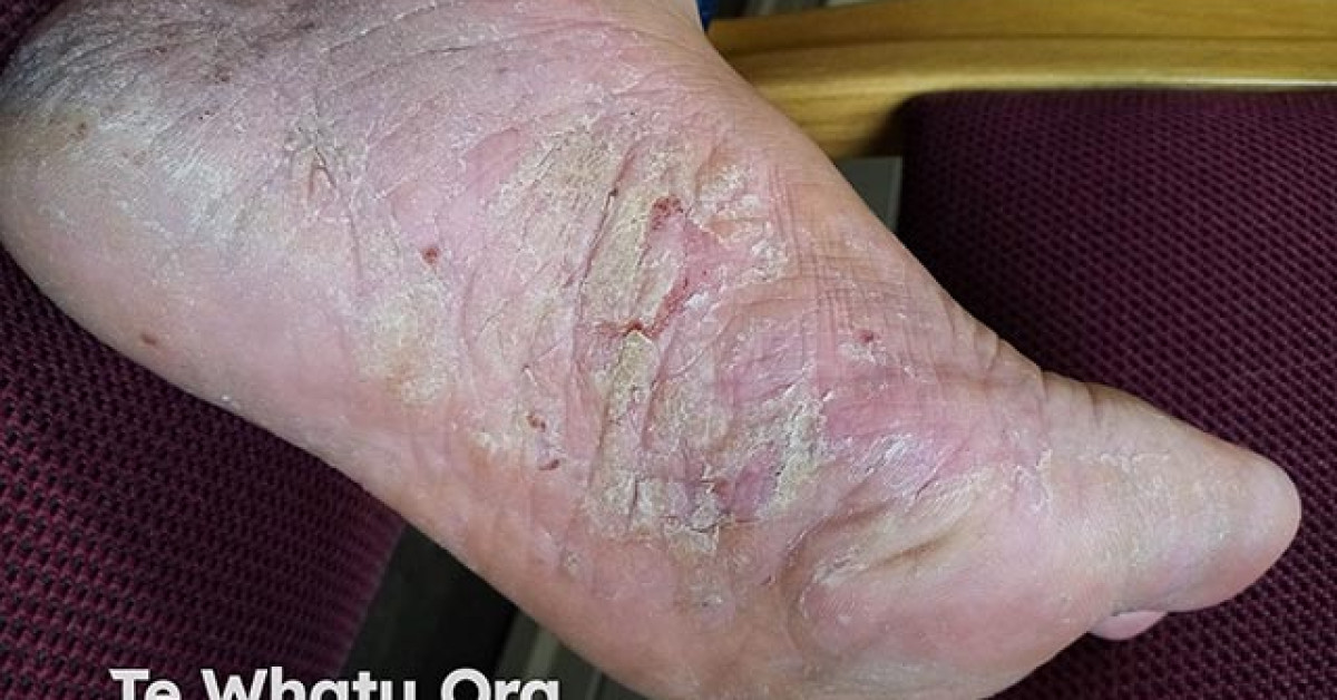 Acquired palmoplantar keratoderma image