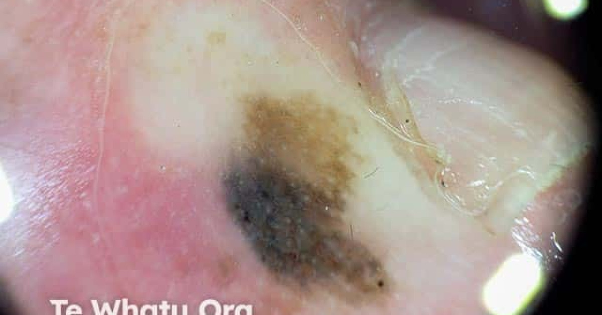 Acral lentiginous melanoma image