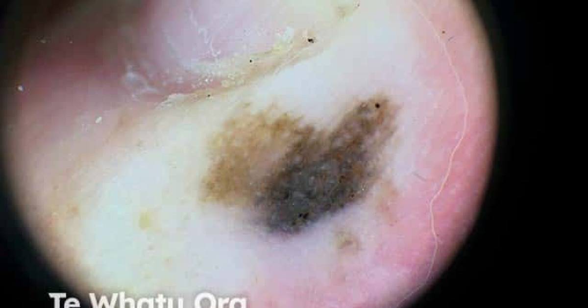 Acral lentiginous melanoma image