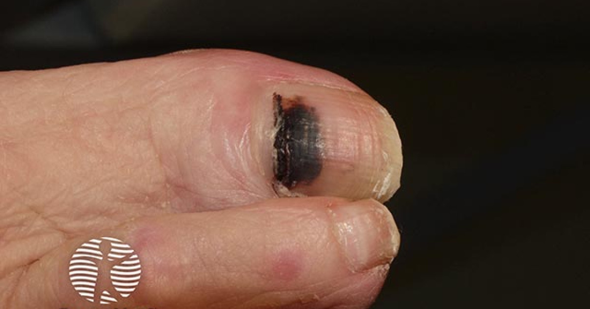 Acral lentiginous melanoma image