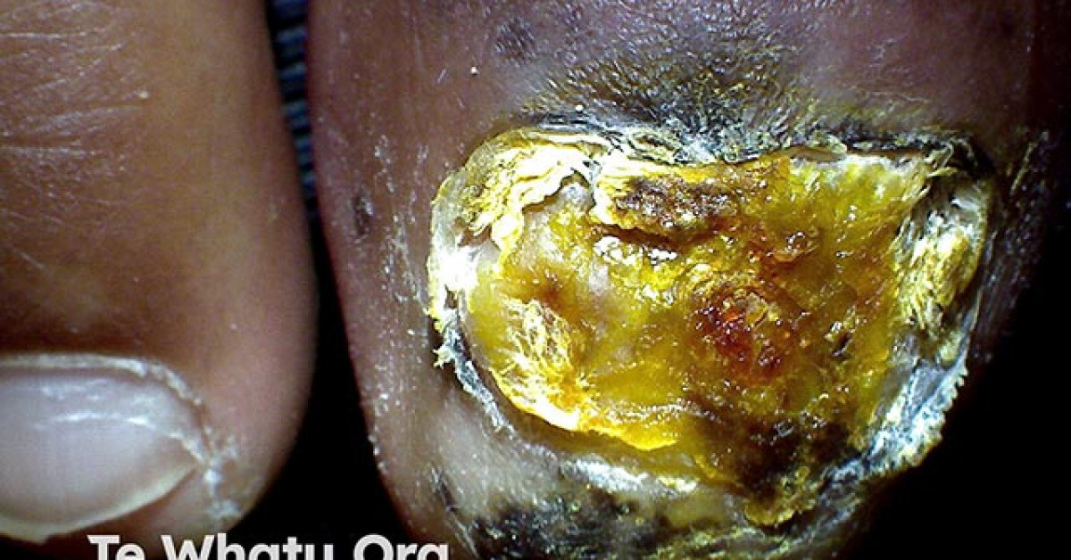 Acral lentiginous melanoma image