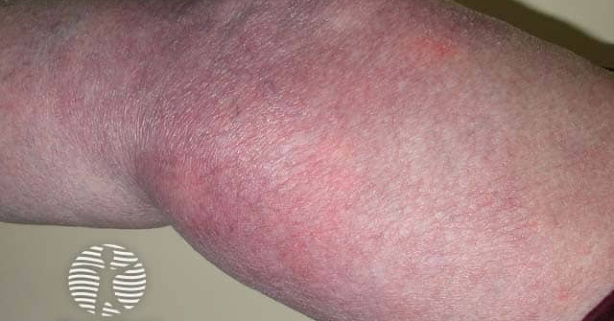 Acrodermatitis chronica atrophicans image