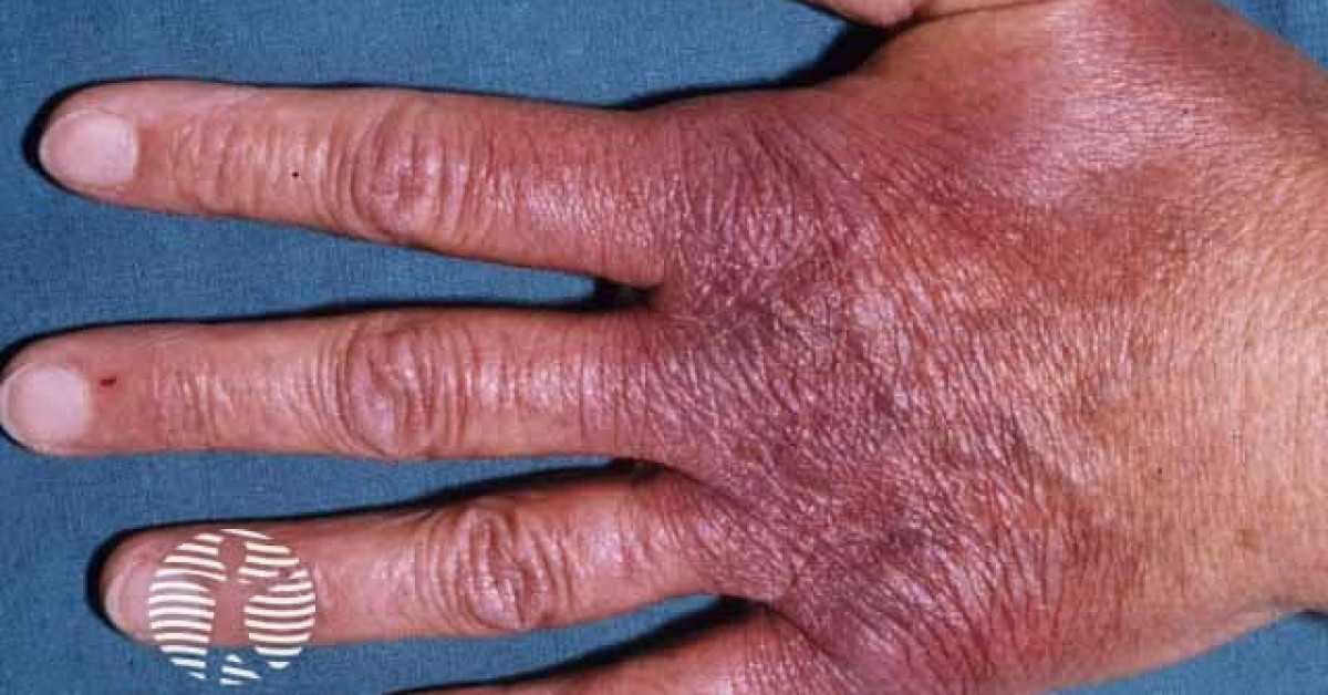 Acrodermatitis chronica atrophicans image