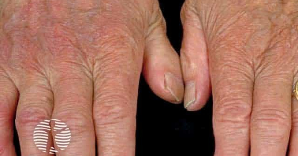 Acrodermatitis chronica atrophicans image