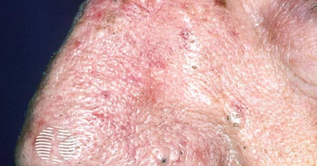 Actinic elastosis image