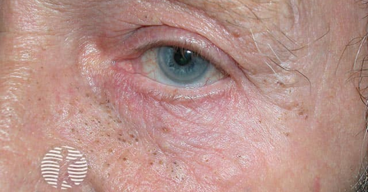 Actinic elastosis image