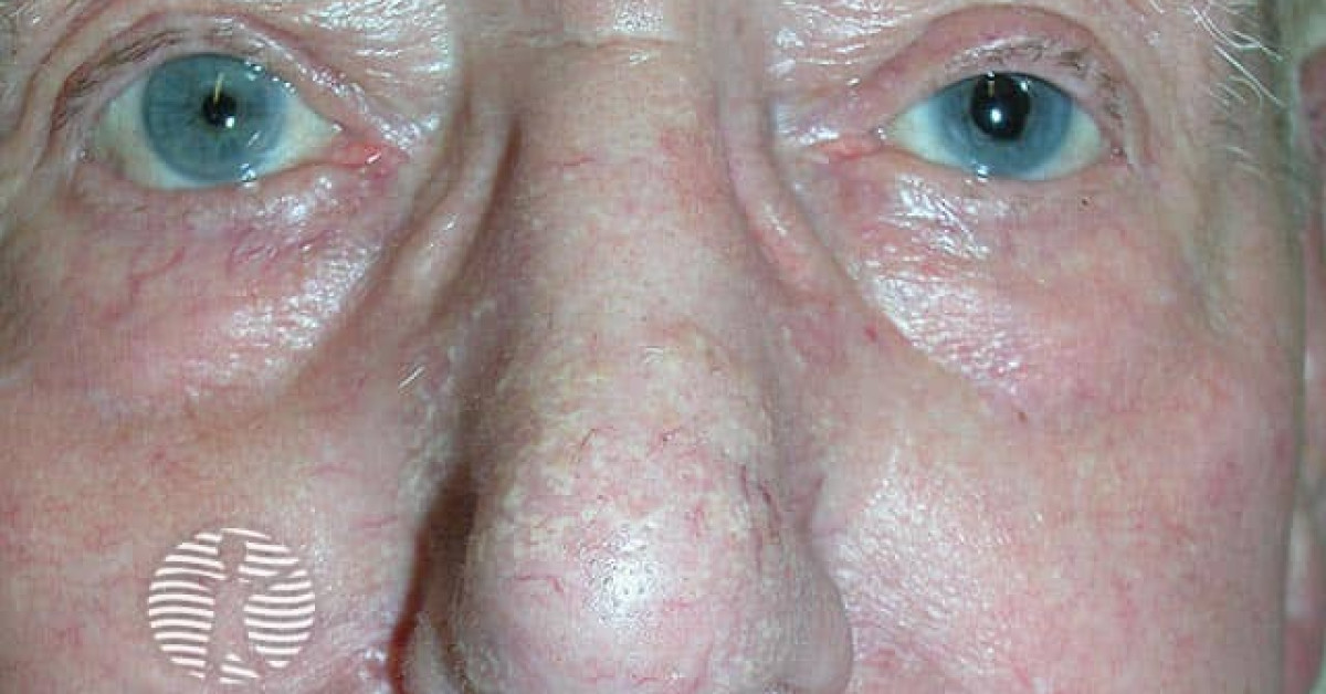 Actinic elastosis image