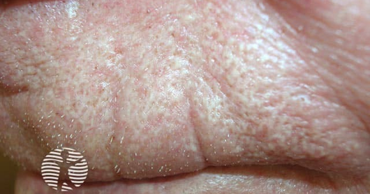 Actinic elastosis image