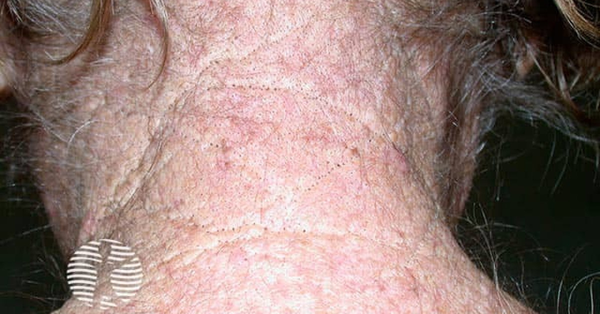 DermNet® - Actinic elastosis image