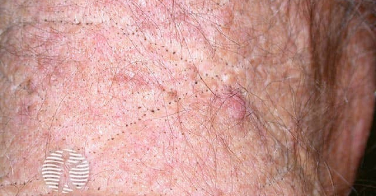 Actinic elastosis image