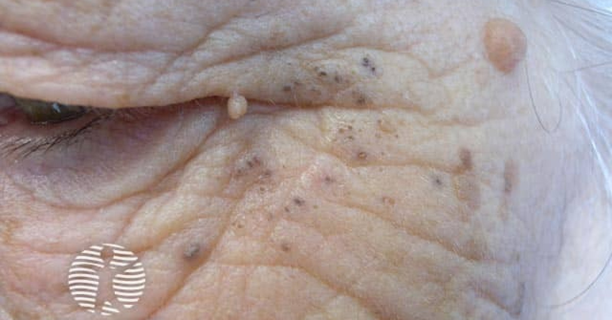 Actinic elastosis image