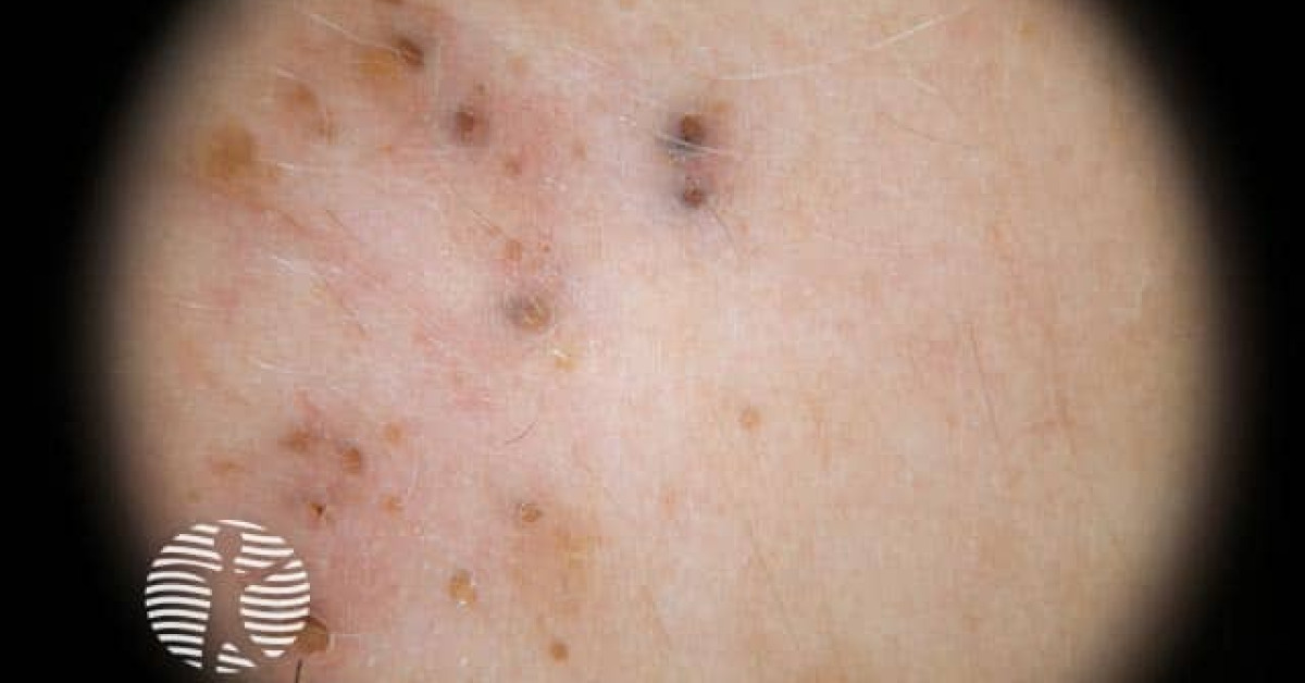 Actinic elastosis image