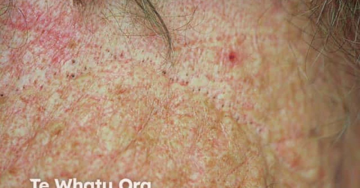 Actinic elastosis image