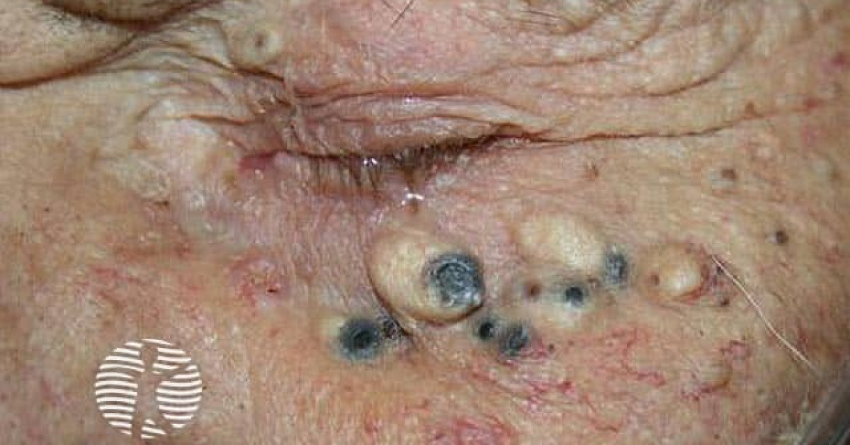 Actinic elastosis image